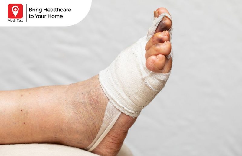 Kaki Bengkak Bernanah, Cara untuk Mempercepat Penyembuhan