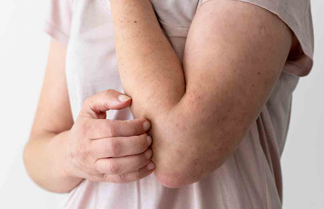 4 Penyebab Alergi Udang, Wajib Dihindari Selagi Mungkin! - Medi Call Blog