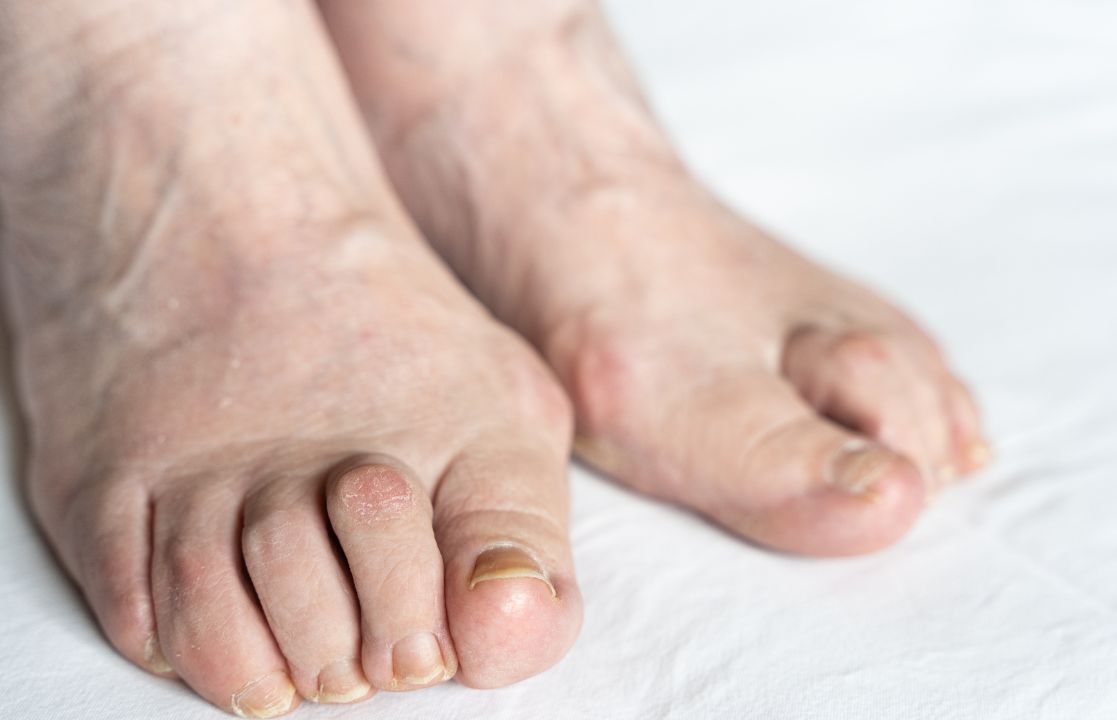 10 Penyebab Kaki Bengkak pada Lansia dan Cara Mengatasinya - Medi Call Blog